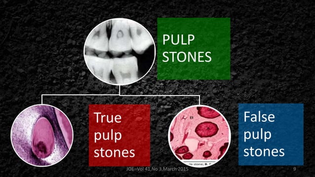Pulp stone | PPT