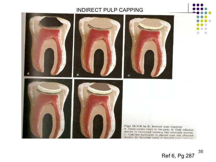 Pulp Therapy by nishtha