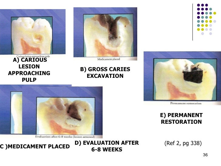 Pulp Therapy by nishtha