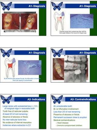 Pulp Therapy | PDF