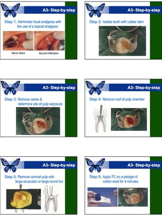 Pulp Therapy | PDF | Dental Health | Diseases and Conditions