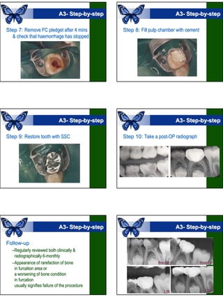 Pulp Therapy | PDF | Dental Health | Diseases and Conditions