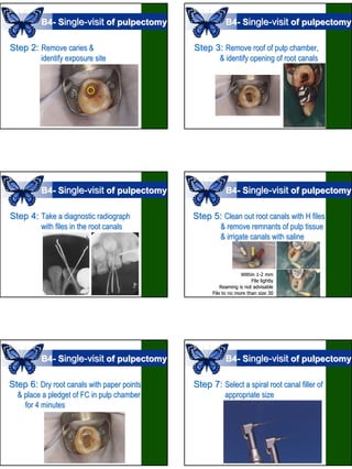 Pulp Therapy | PDF | Dental Health | Diseases and Conditions