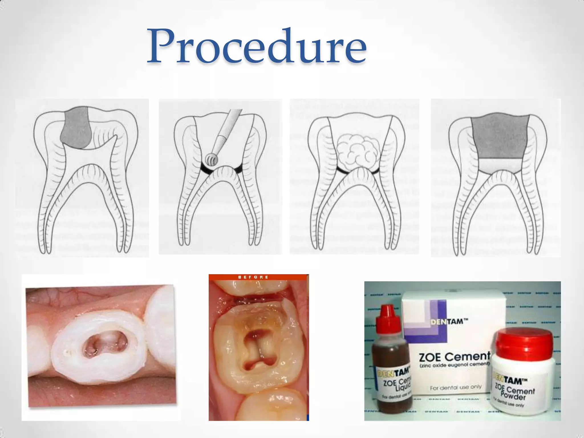 Tip of the week - Pulp therapy | PPT