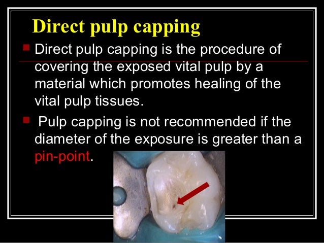 Pulp therapy for primary and young teeth