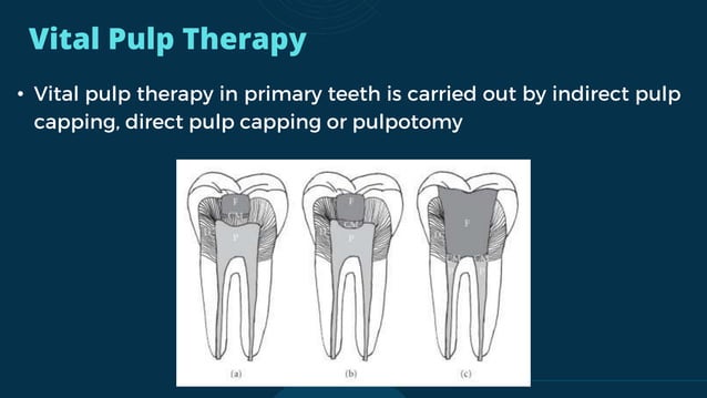 Pulp therapy for primary dentition..pptx