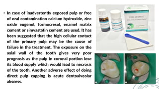 Pulp therapy for primary dentition..pptx