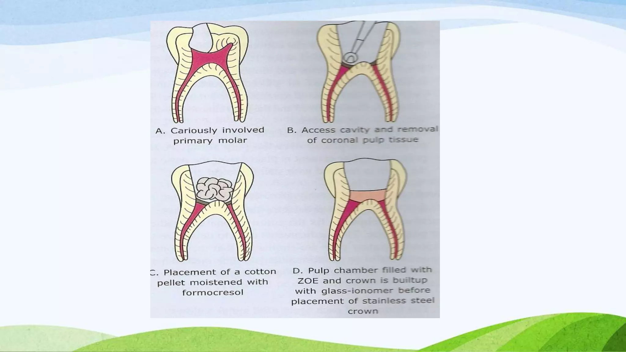 Pulp therapy in pediatric dentistry | PPT