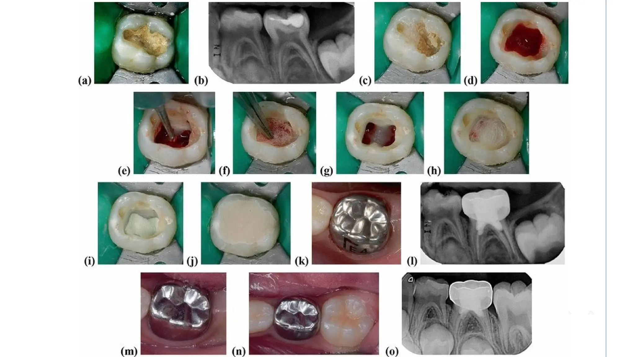 PULP therapy in primary teeth..... pptx | PPTX