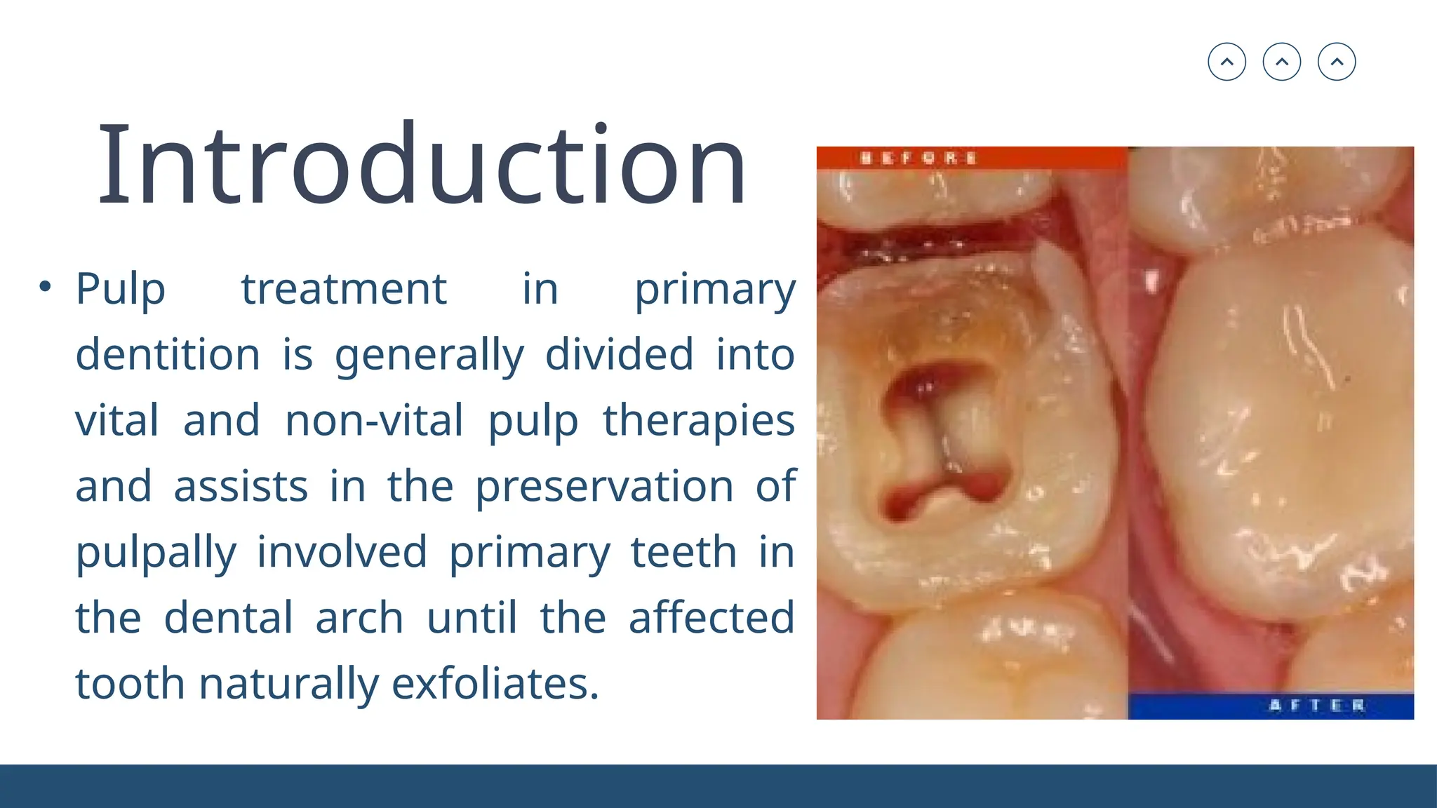 PULP therapy in primary teeth..... pptx | PPTX