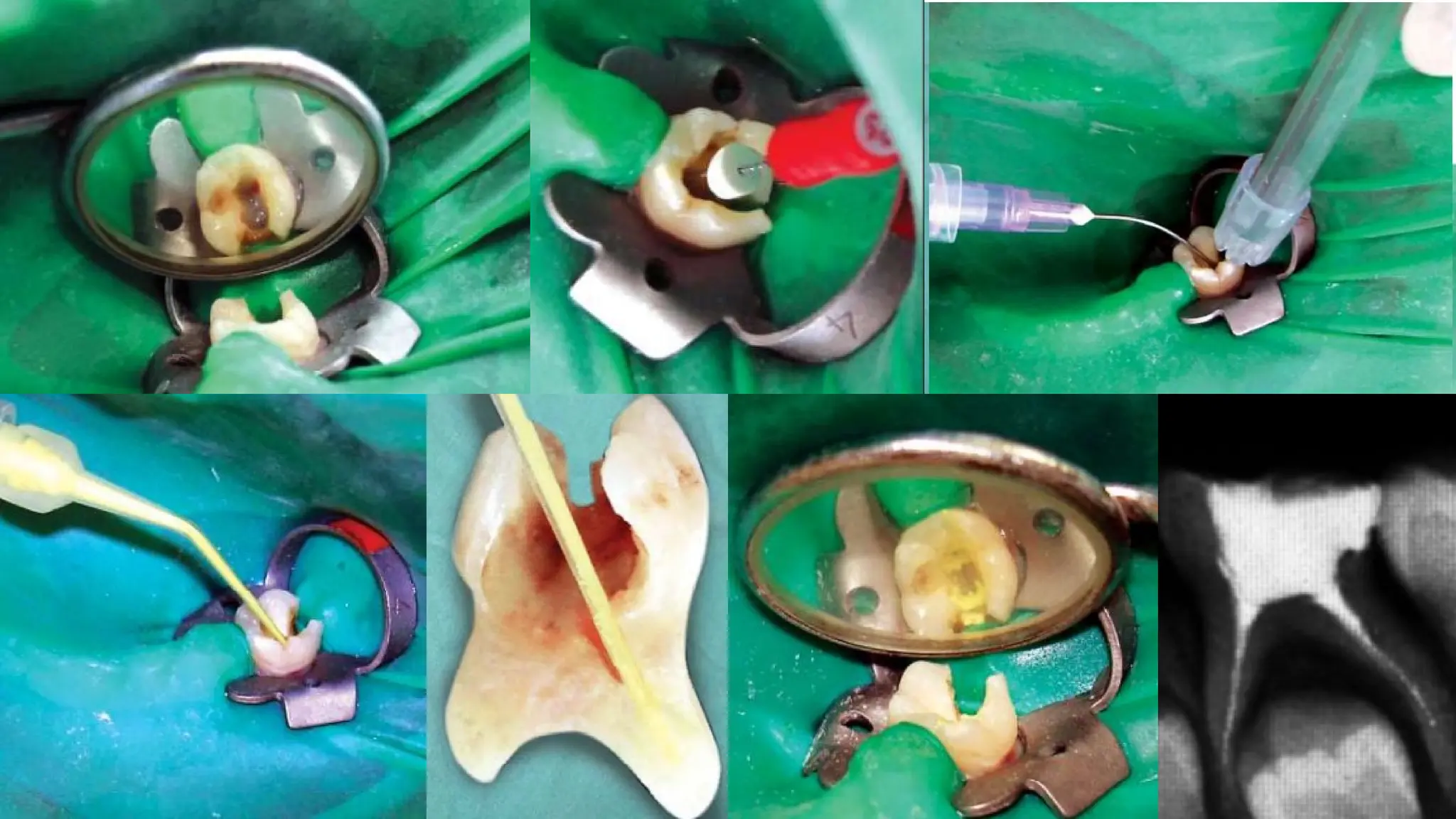 PULP therapy in primary teeth..... pptx | PPTX