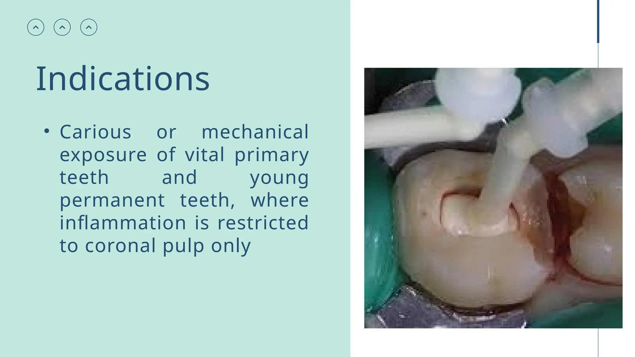 PULP therapy in primary teeth..... pptx | PPTX