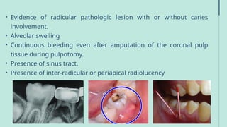 PULP therapy in primary teeth..... pptx | PPTX