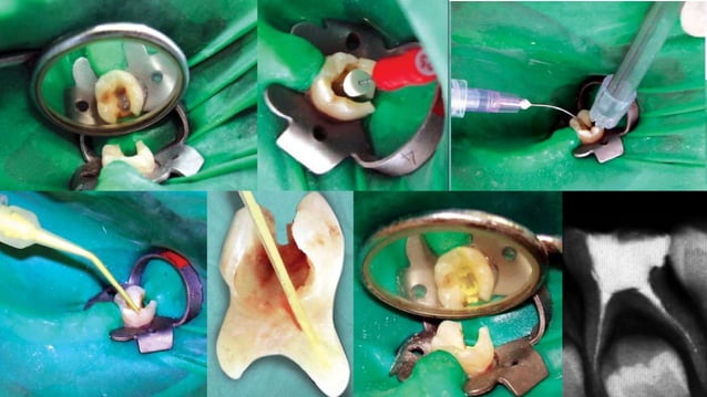 PULP therapy in primary teeth..... pptx | PPTX | Dental Health ...