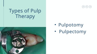 PULP therapy in primary teeth..... pptx | PPTX