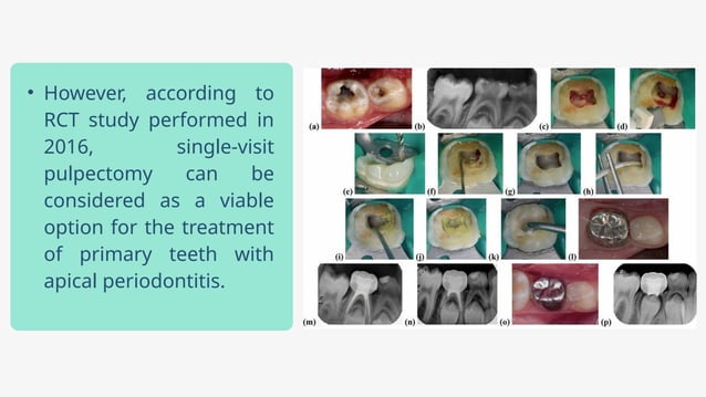 PULP therapy in primary teeth..... pptx | PPTX | Dental Health ...