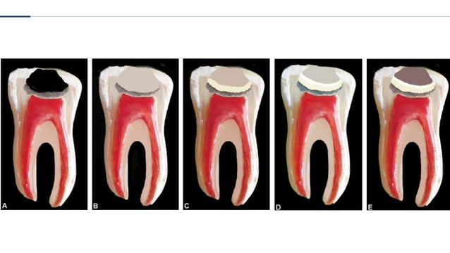 PULP therapy in primary teeth..... pptx | PPTX | Dental Health ...