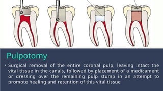 PULP therapy in primary teeth..... pptx | PPTX