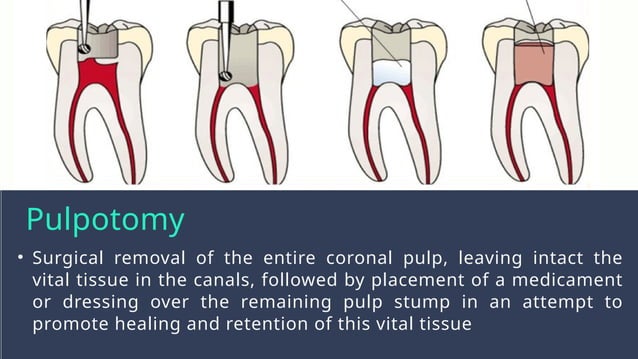 PULP therapy in primary teeth..... pptx | PPTX | Dental Health ...