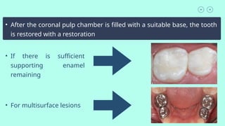 PULP therapy in primary teeth..... pptx | PPTX