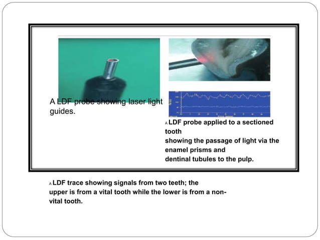 Pulp vitality test new | PPT | Dental Health | Diseases and Conditions