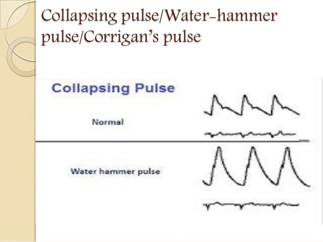 Pulse- Abnormal Findings