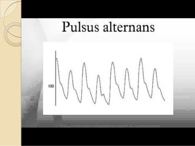 Pulse- Abnormal Findings