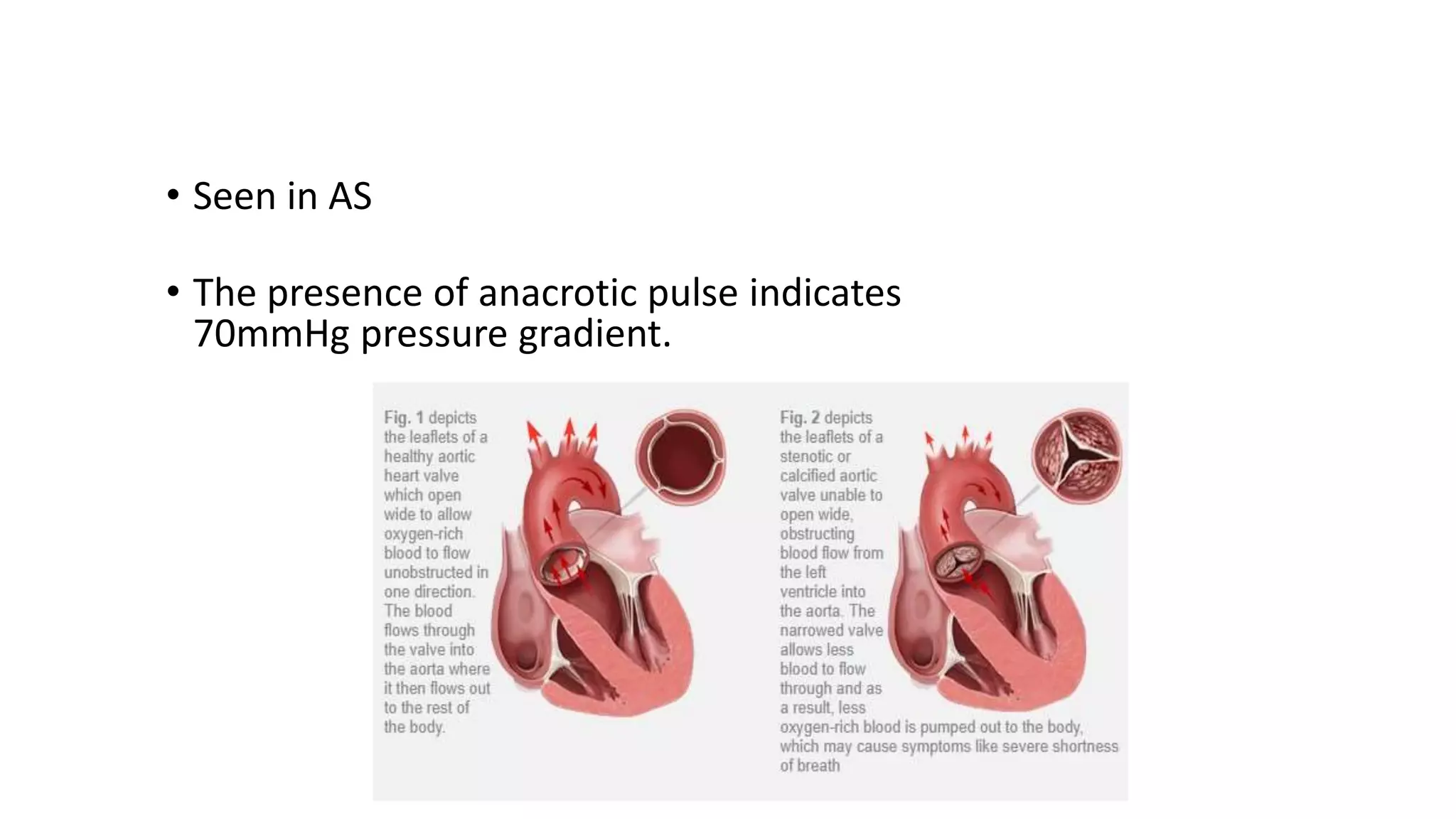 Pulse - Arterial Pulse - Types | PPTX | Heart and Cardiovascular ...