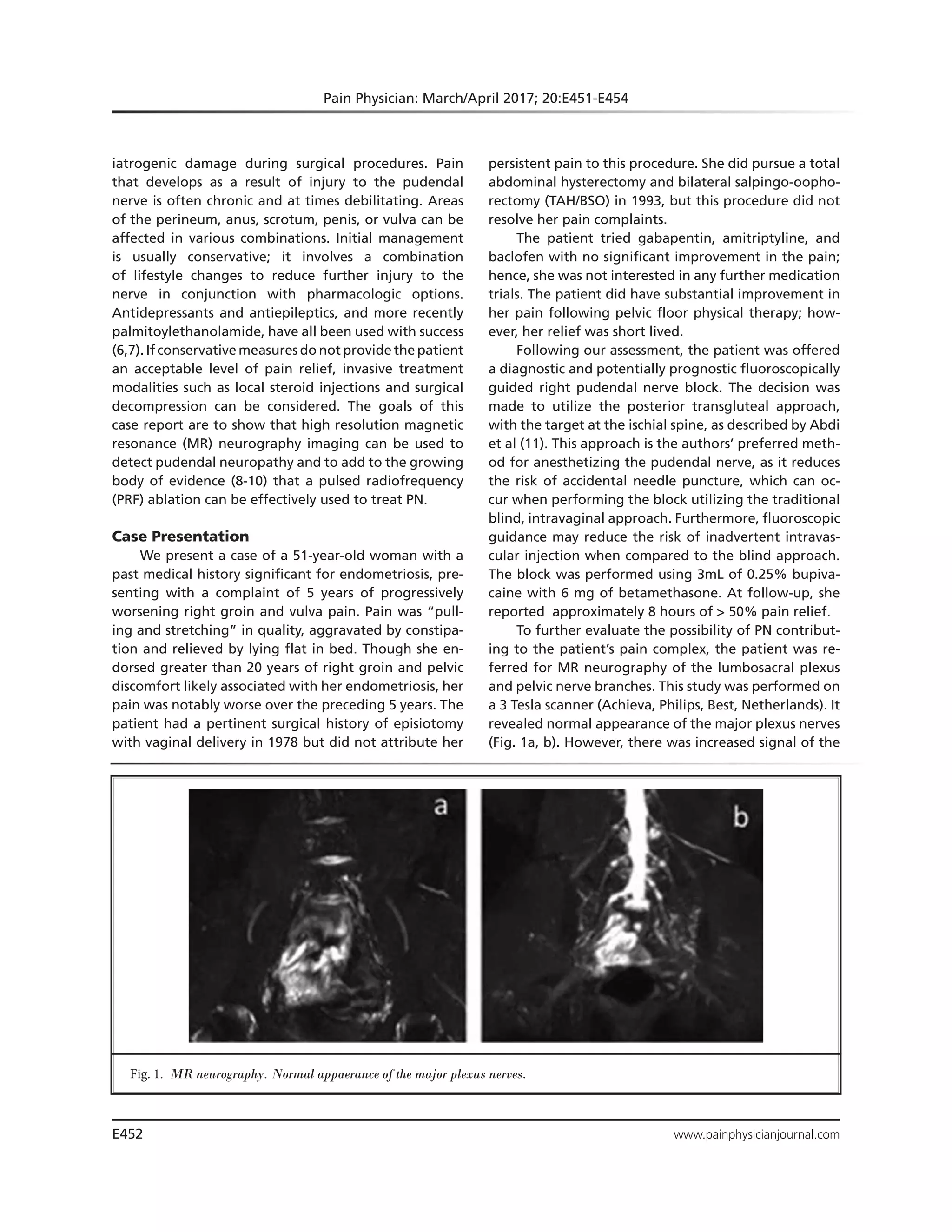 Pulsed radiofrequency ablation of pudendal nerve for treatment of a case of refractory pelvic ...