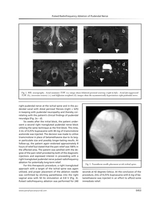 Pulsed radiofrequency ablation of pudendal nerve for treatment of a case of refractory pelvic ...