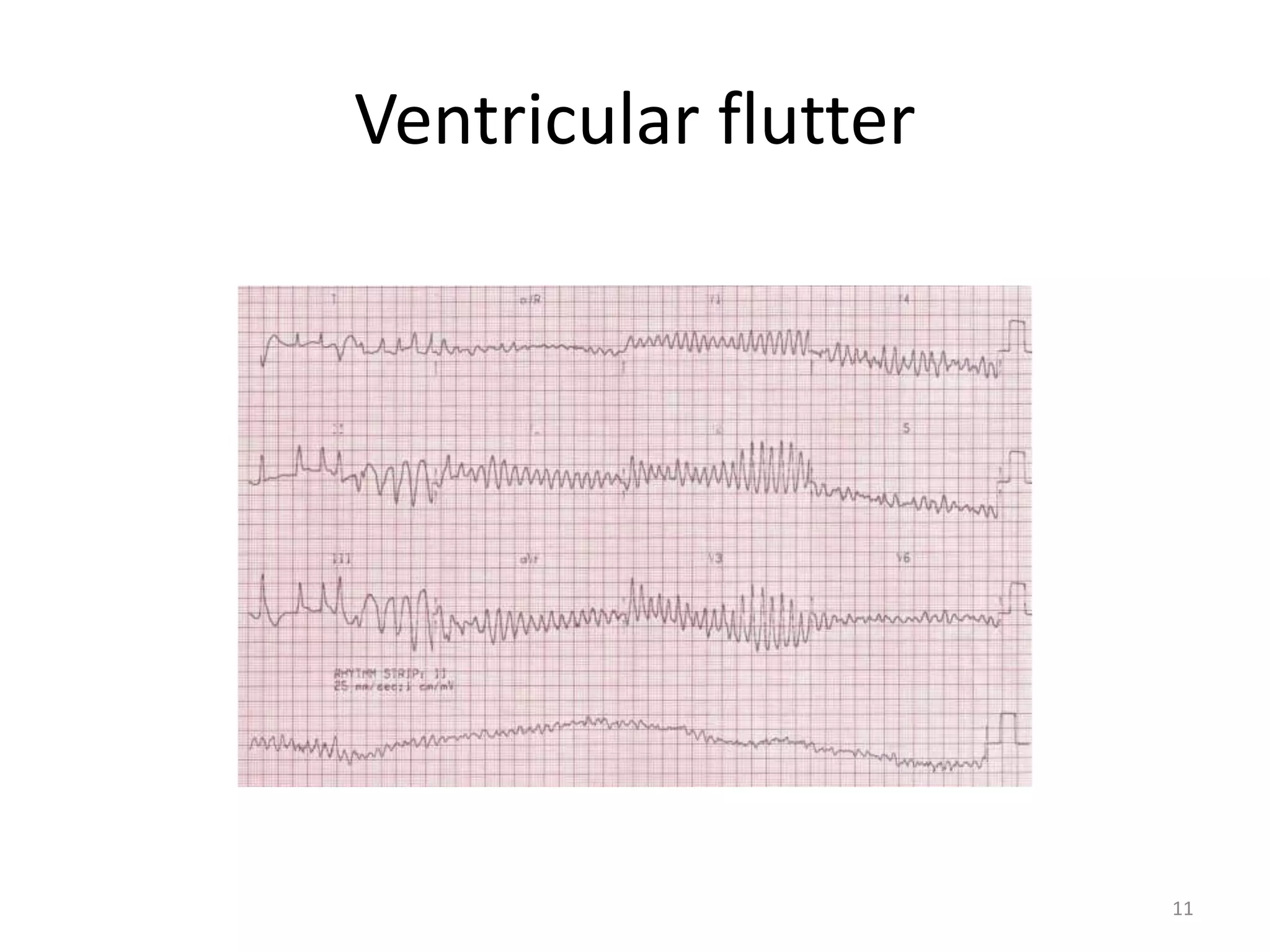 Pulseless electrical activity, Ventricular flutter, Ventricular ...