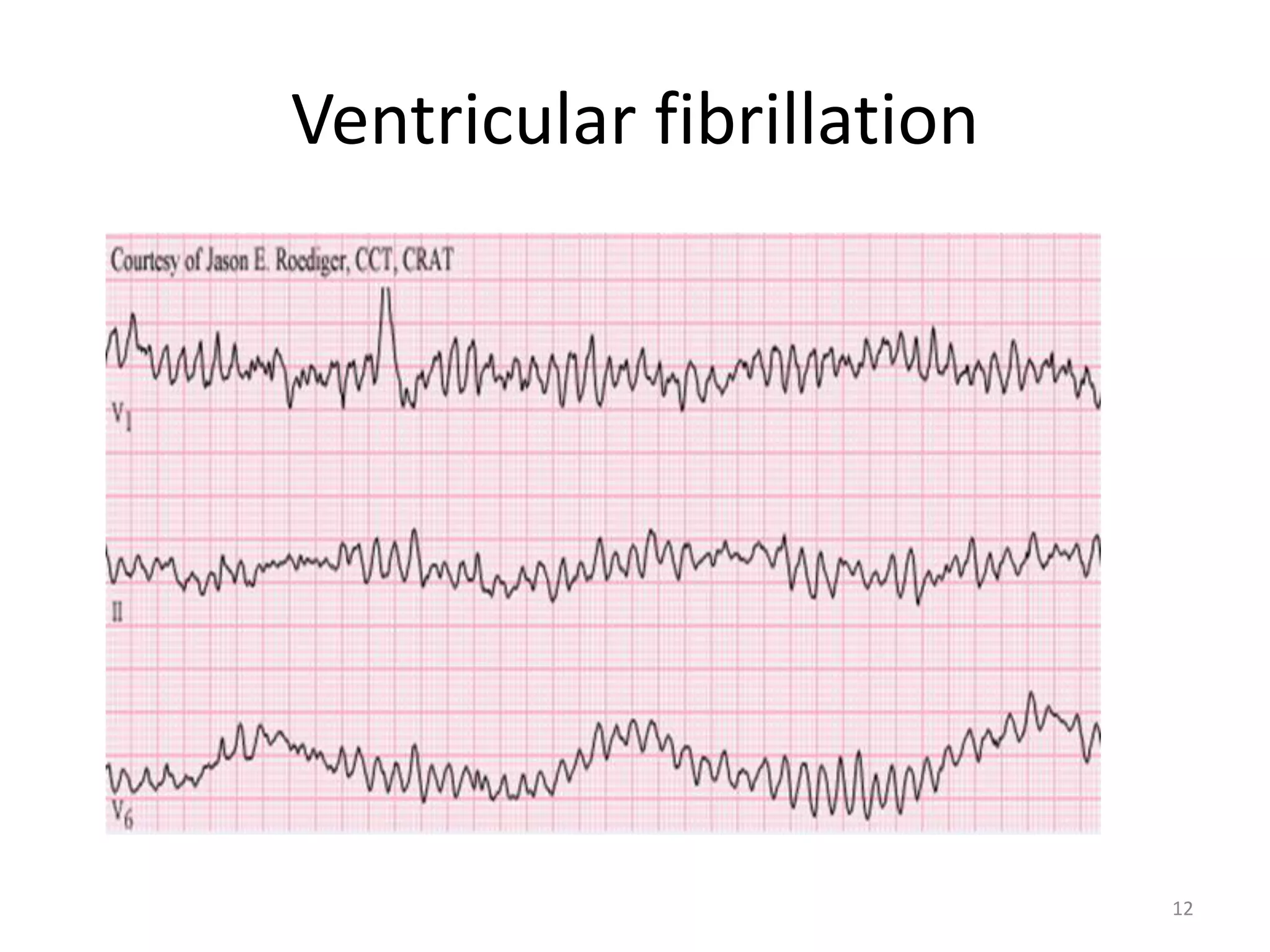 Pulseless electrical activity, Ventricular flutter, Ventricular ...