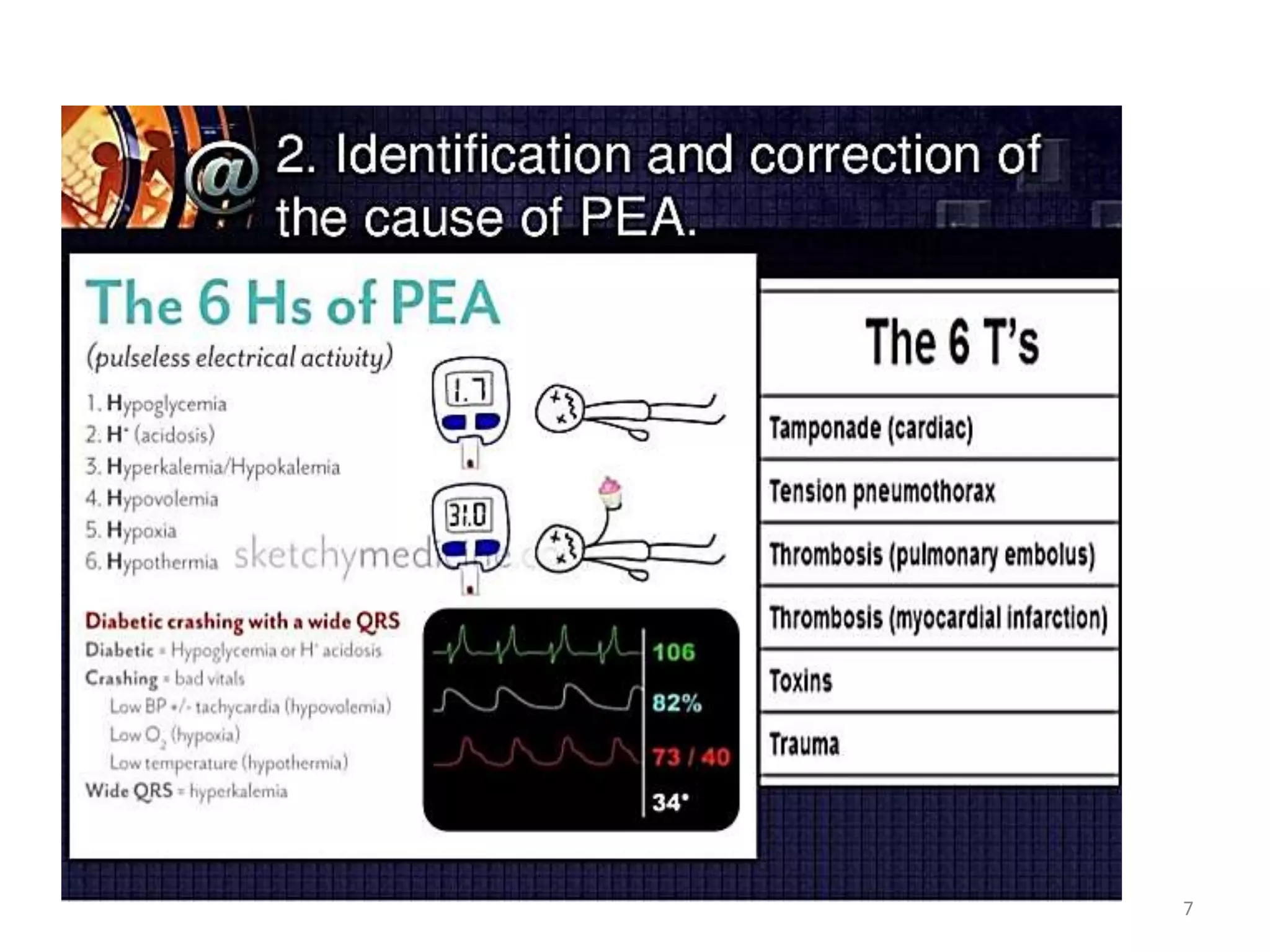 Pulseless electrical activity, Ventricular flutter, Ventricular ...