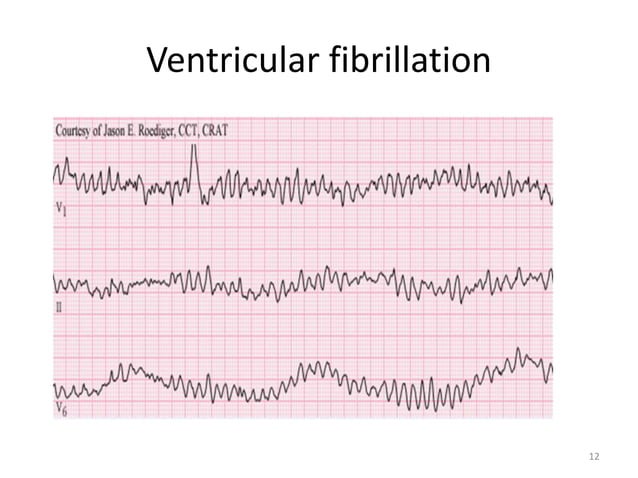 Pulseless electrical activity, Ventricular flutter, Ventricular ...
