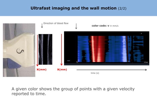 Pulse wave velocity ssid02688 03 | PDF | Heart and Cardiovascular Diseases | Diseases and Conditions