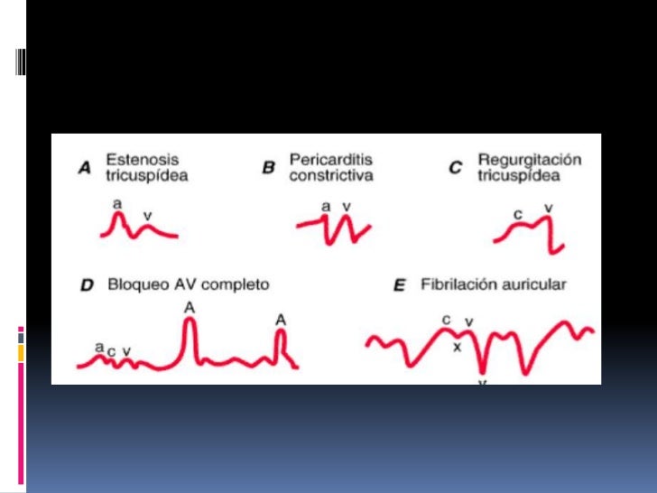 Pulso venoso yugular