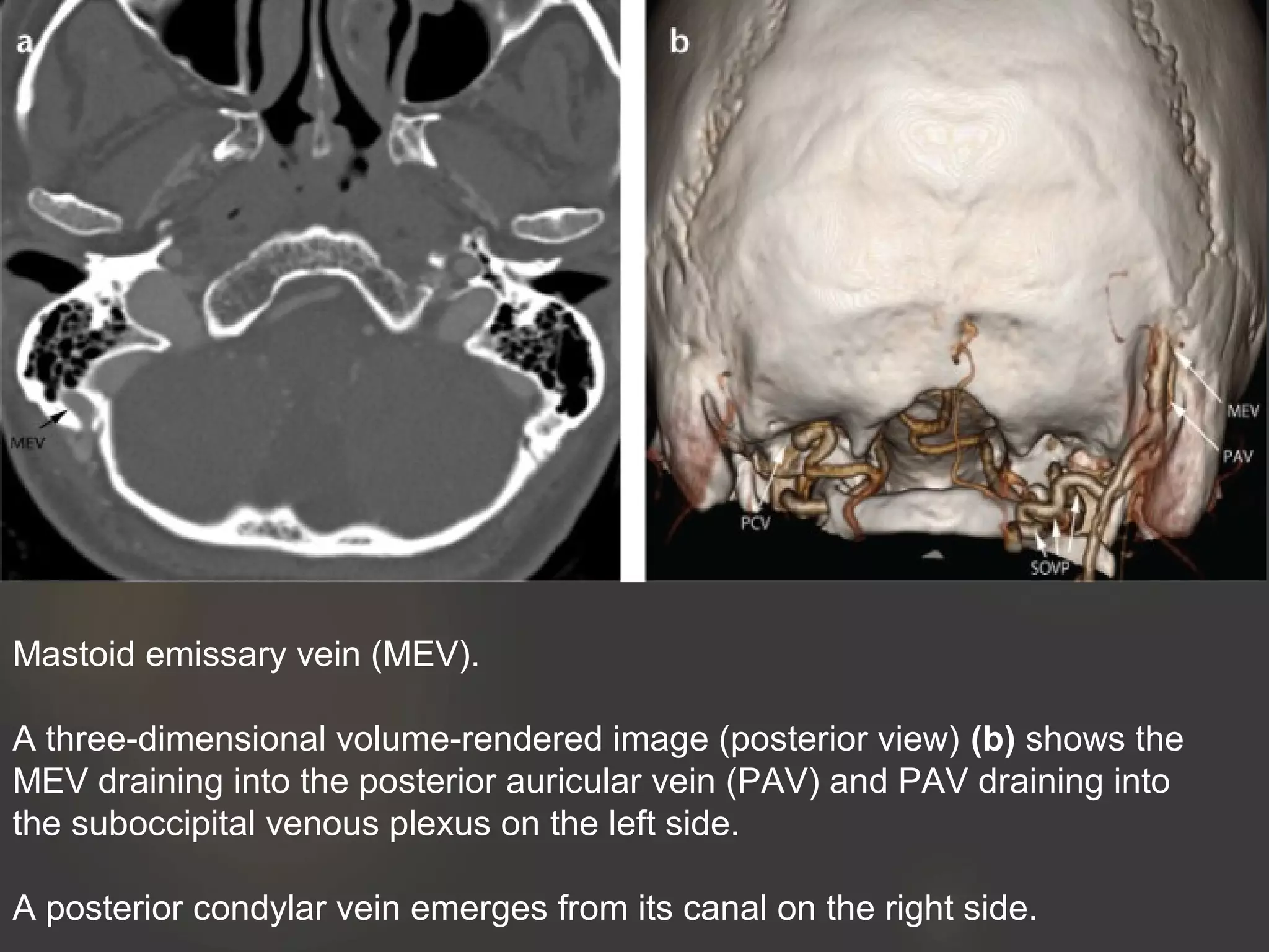 Pulstaile tinitus radiology | PPT