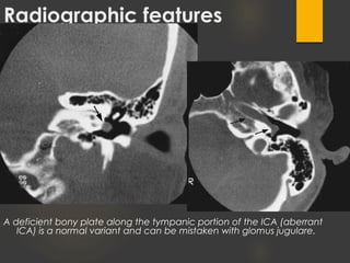 Pulstaile tinitus radiology | PPT