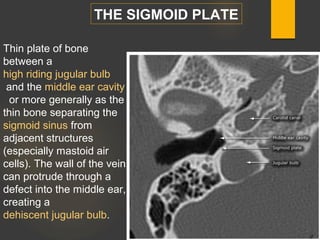 Pulstaile tinitus radiology | PPT