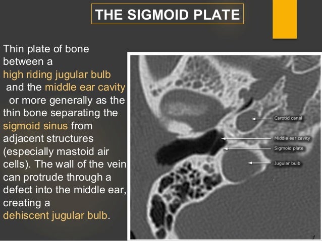 Pulstaile tinitus radiology