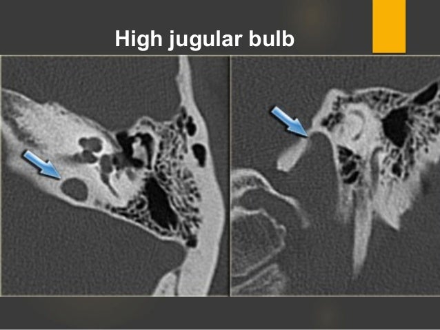 Pulstaile tinitus radiology