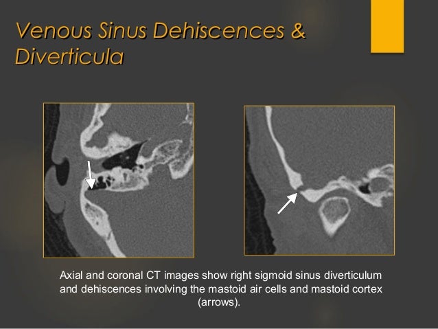 Pulstaile tinitus radiology