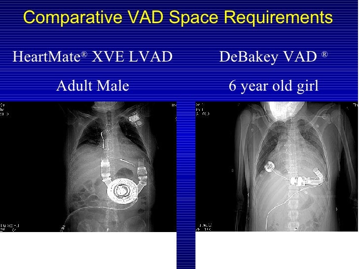 Development of an Axial Flow Left Ventricular Assist Device (LVAD) fr…
