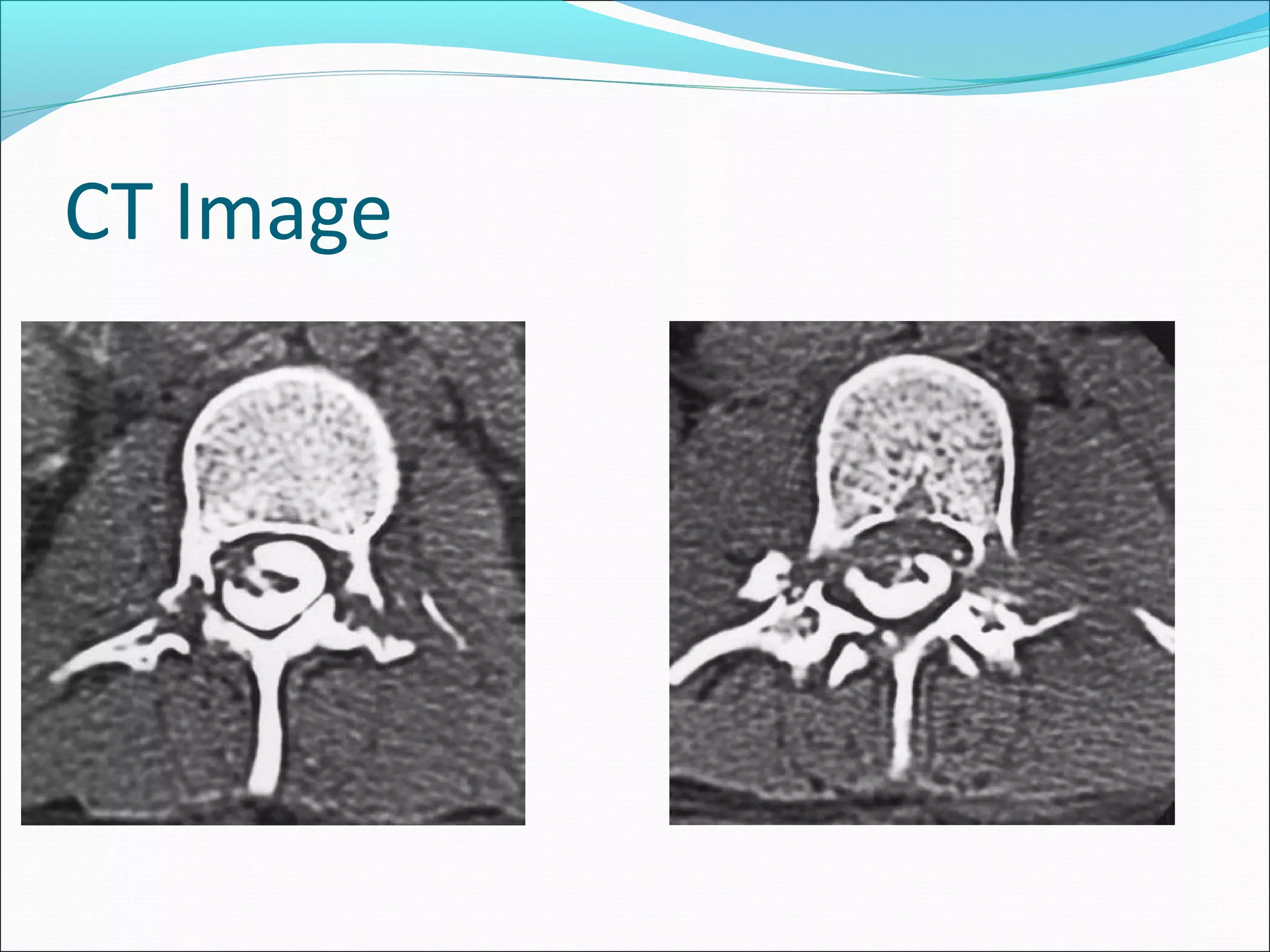 Traumatic Spondylolisthesis | PPT