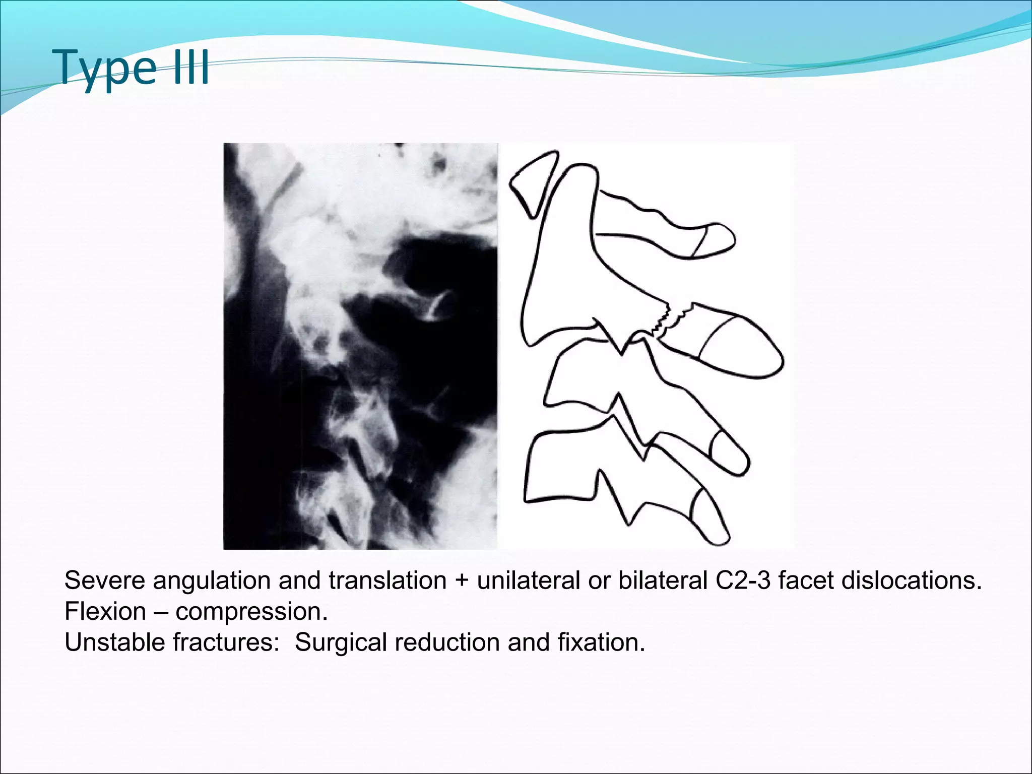 Traumatic Spondylolisthesis | PPT