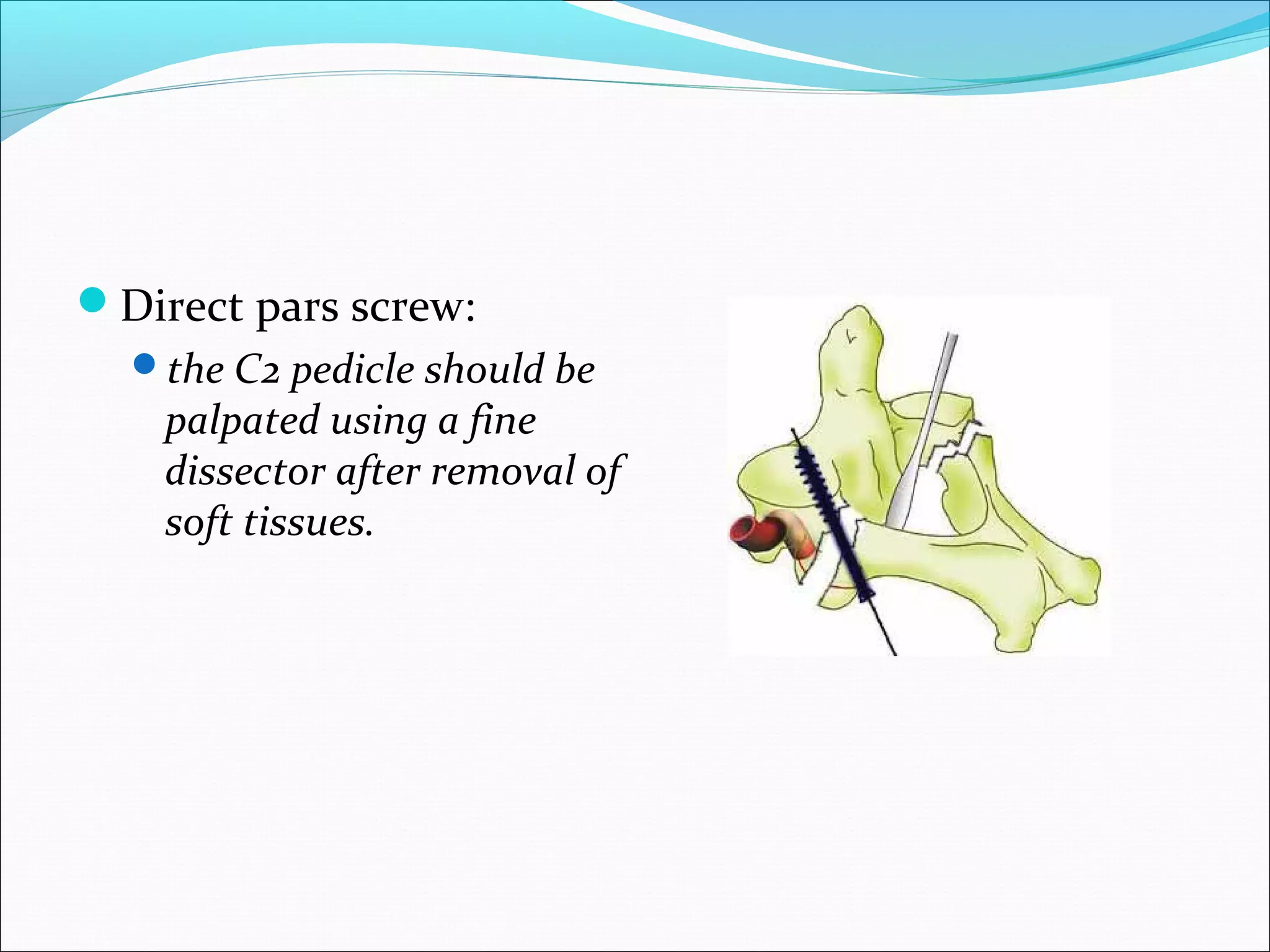 Traumatic Spondylolisthesis | PPT