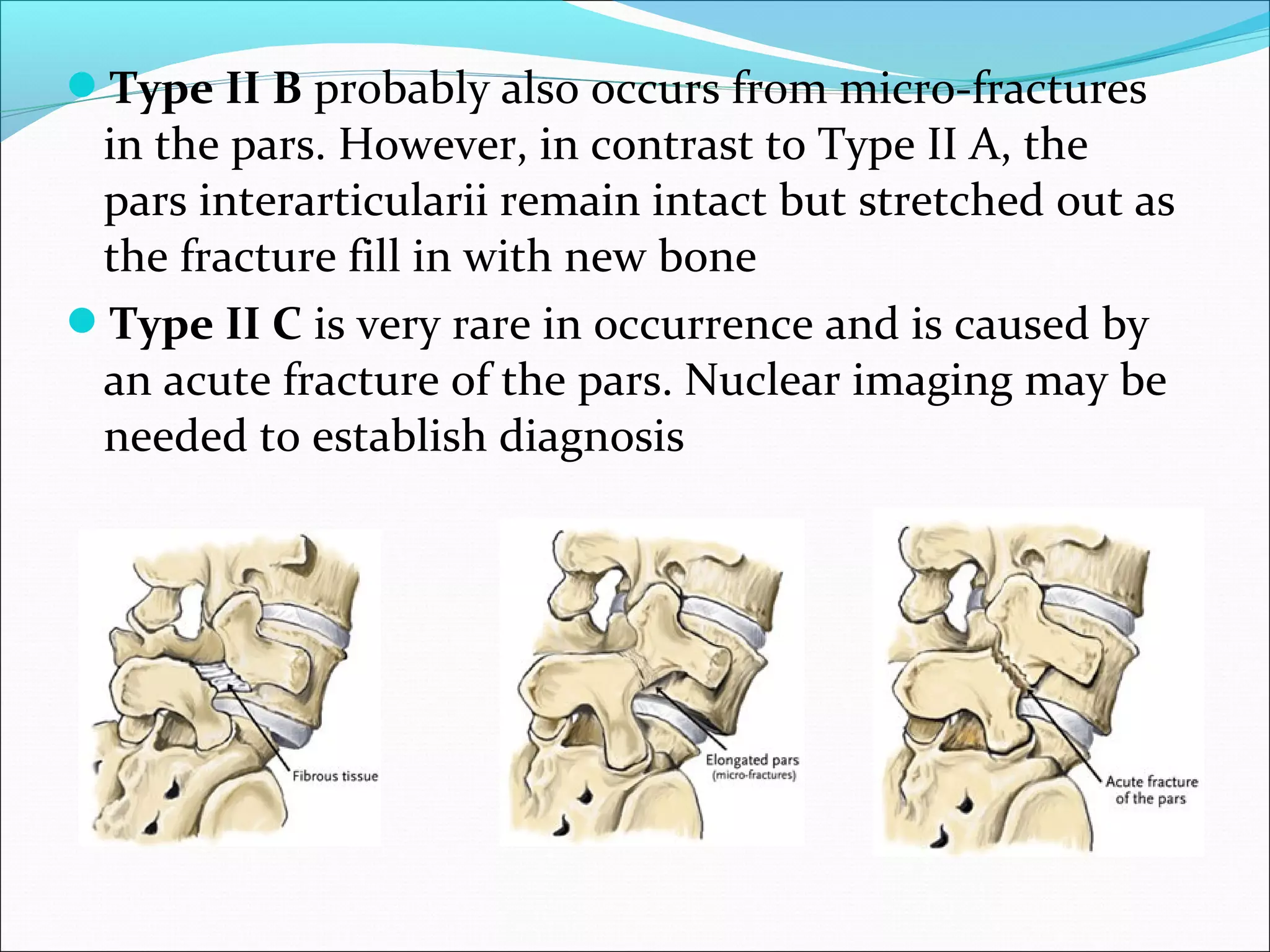 Traumatic Spondylolisthesis | PPT