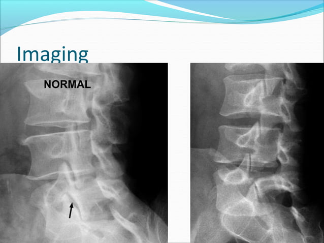 Traumatic Spondylolisthesis | PPT
