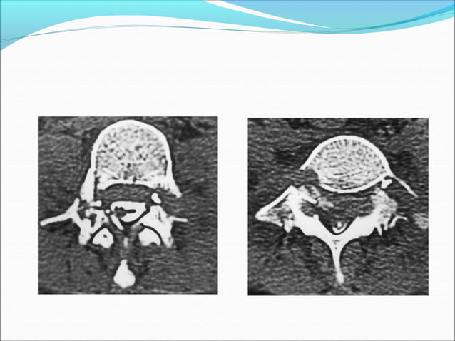 Traumatic Spondylolisthesis | PPT