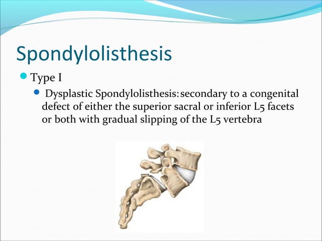 Traumatic Spondylolisthesis | PPT